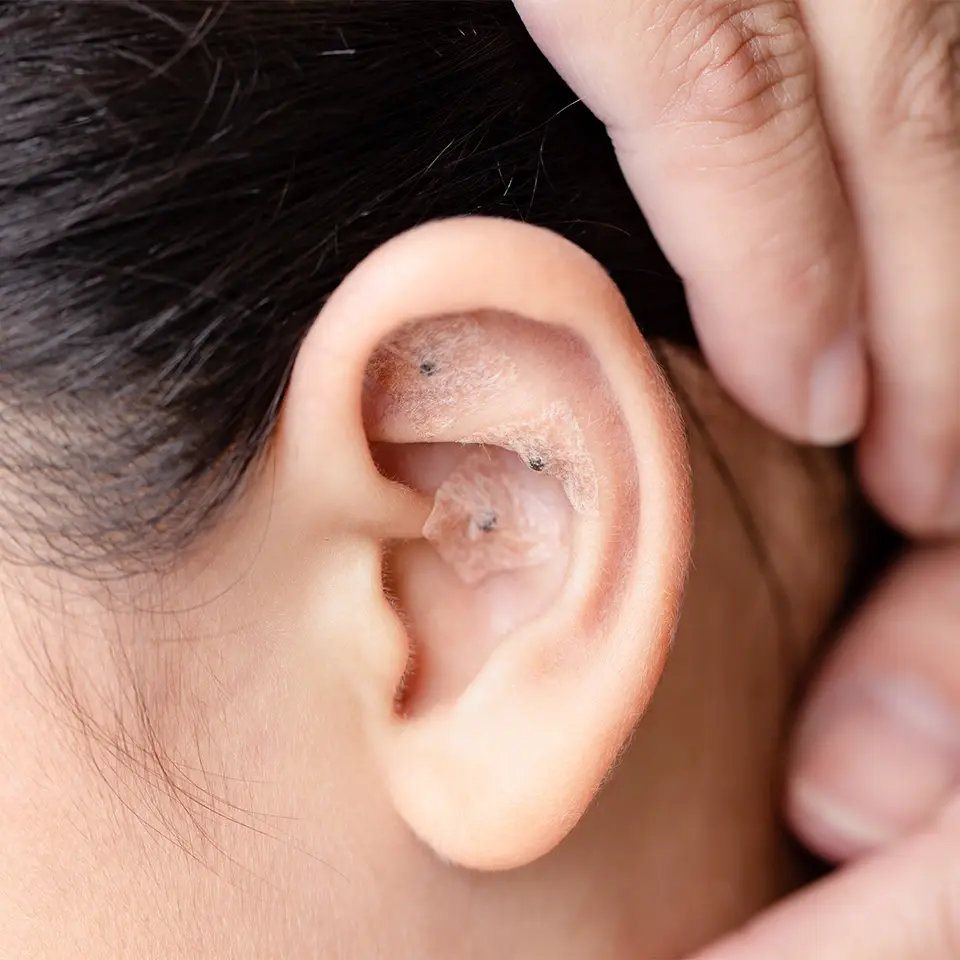 Ear Seeding Online Course | Accredited Online Diploma